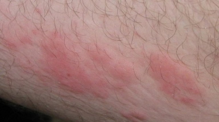 Oboljenja kože – Kako Leciti